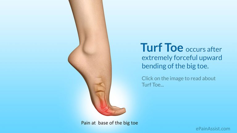 Got turf toe?