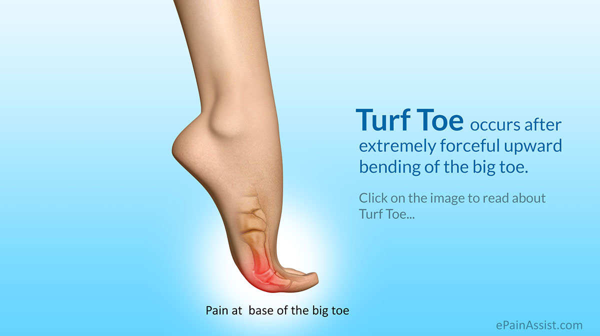 Got turf toe?
